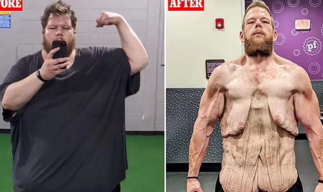 Obezi humbet 152 kg por i mbetet lëkura e varur në gjithë trupin ...